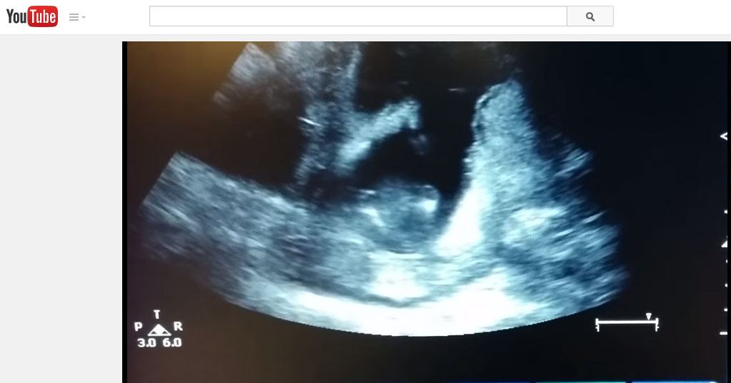 Ultrasound video shows fetus clapping | wcnc.com